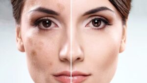 Enlever les taches brunes sur le visage et le corps | Laser pour ...
